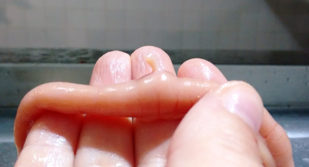 Meckel's diverticulum - Minervet